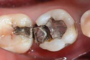 Treatment of Broken Fillings in Thornton, CO - Glacier Peak Dentistry