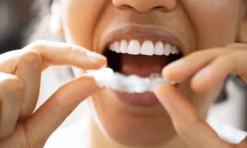 Do you Need a Night Guard? Everything You Need to Know. - Glacier Peak ...