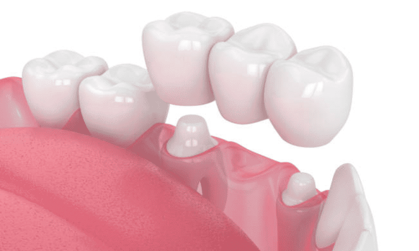 An Overview of Dental Bridges to Replace Missing Teeth - Glacier Peak ...