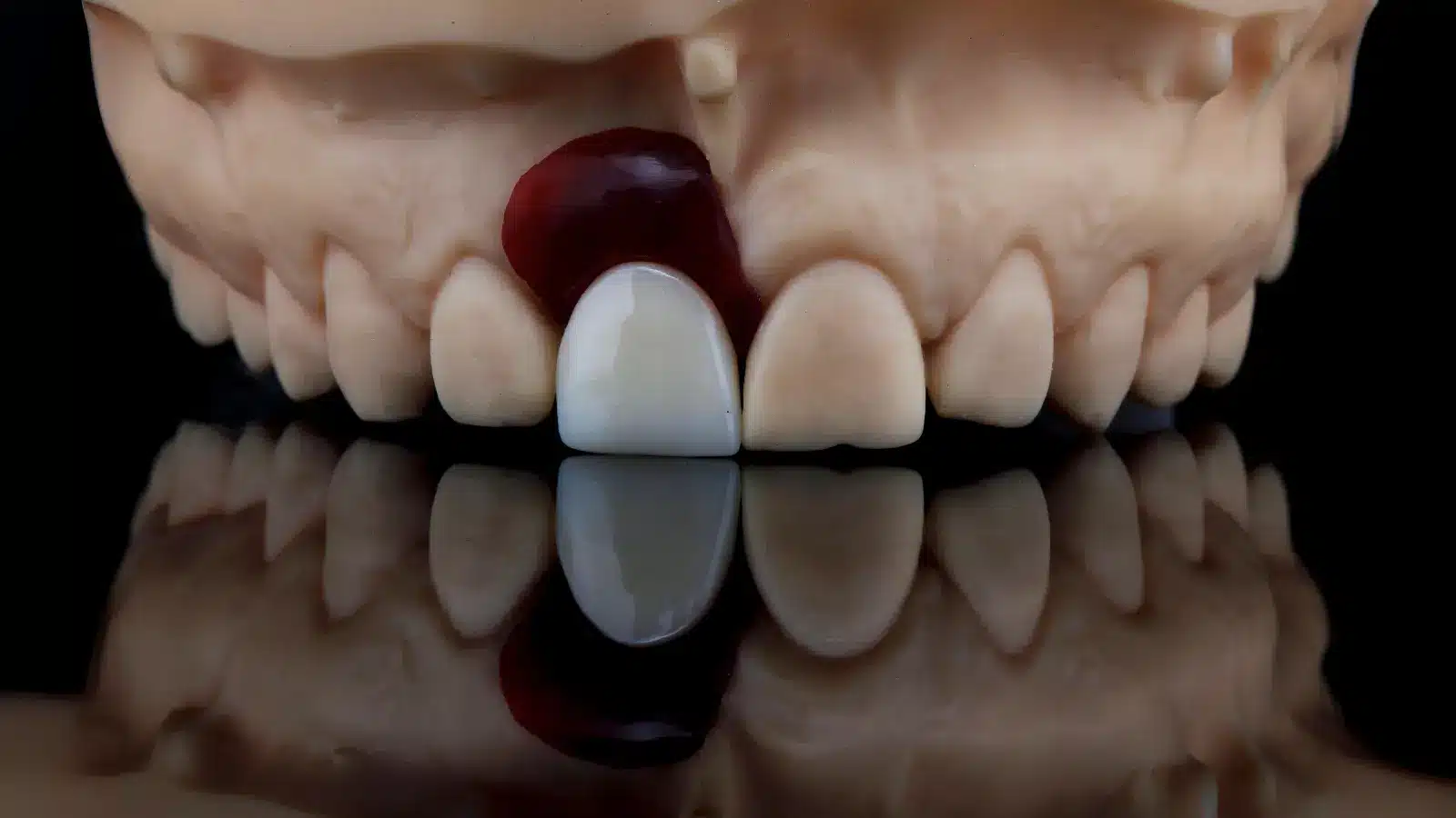 Say Goodbye To Tooth Sensitivity With Soft Tissue Grafts - Glacier Peak ...